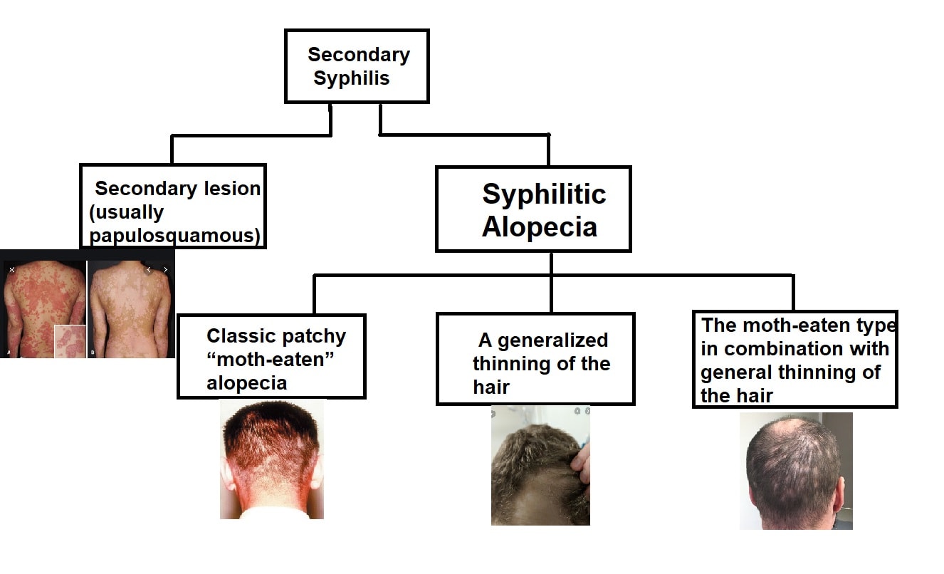 Hair loss due to STD? Yes, that’s possible check out different symptoms ...
