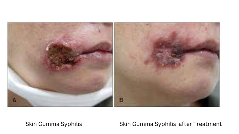 Syphilis Gumma Pictures Symptoms Diagnosis And Prevention Std Testing Near Me