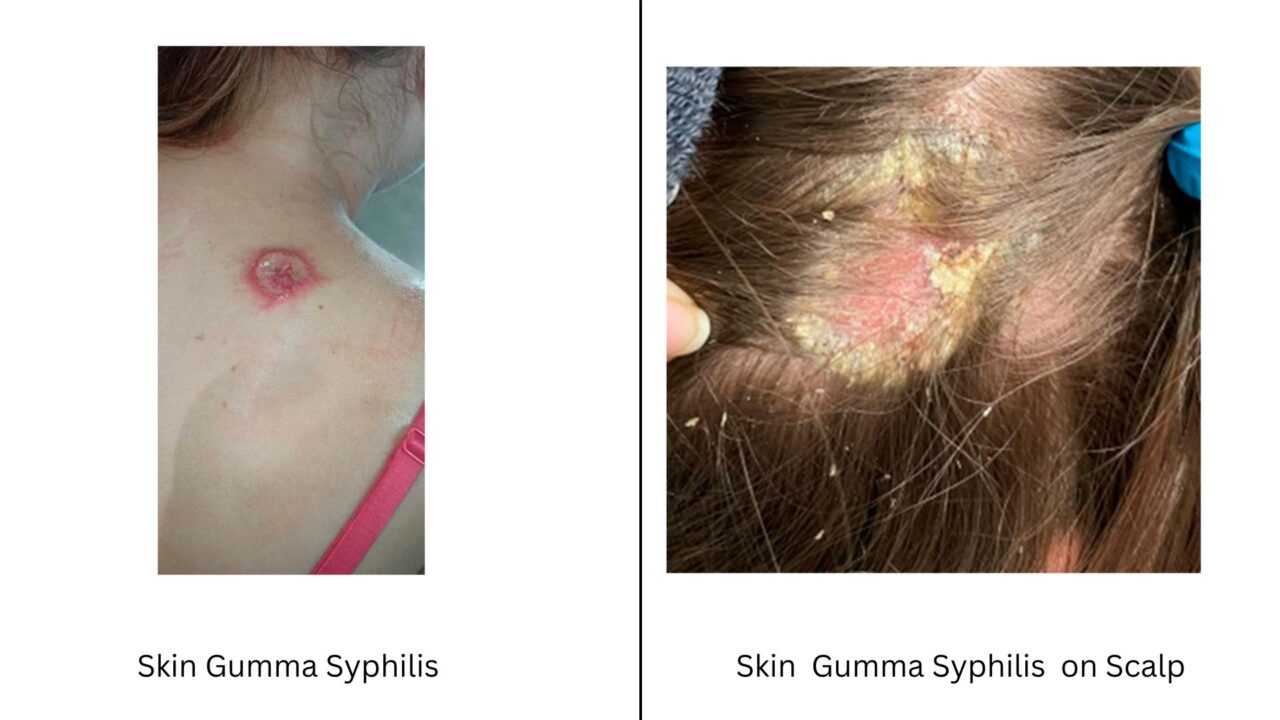 Syphilis Gumma Pictures Symptoms Diagnosis And Prevention Std Testing Near Me