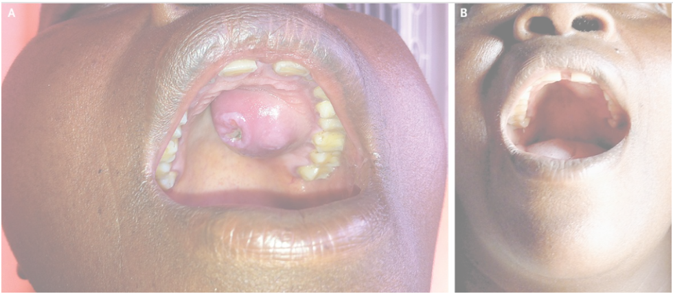 Syphilis Gumma Pictures Symptoms Diagnosis And Prevention Std Testing Near Me